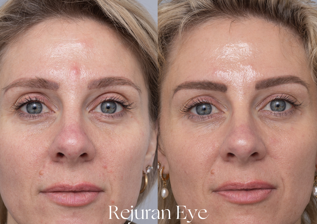 Skin Rejuvenation with Rejuran – Lasers in Medicine