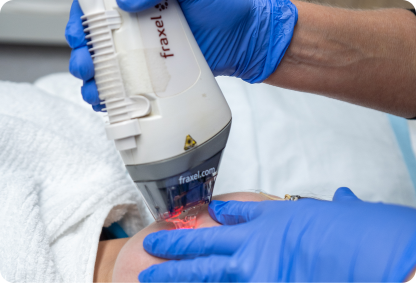 Fraxel – Lasers in Medicine