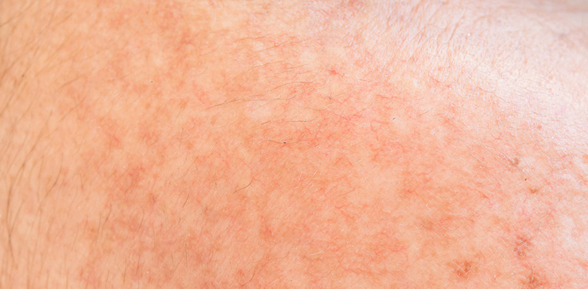 Sun-Damaged Skin – Lasers in Medicine